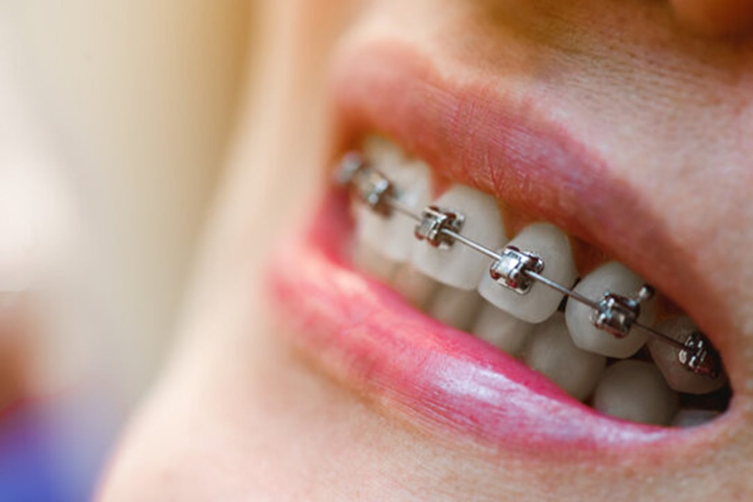 Traditional Braces vs. Self-Ligating | Simply Orthodontics Grafton